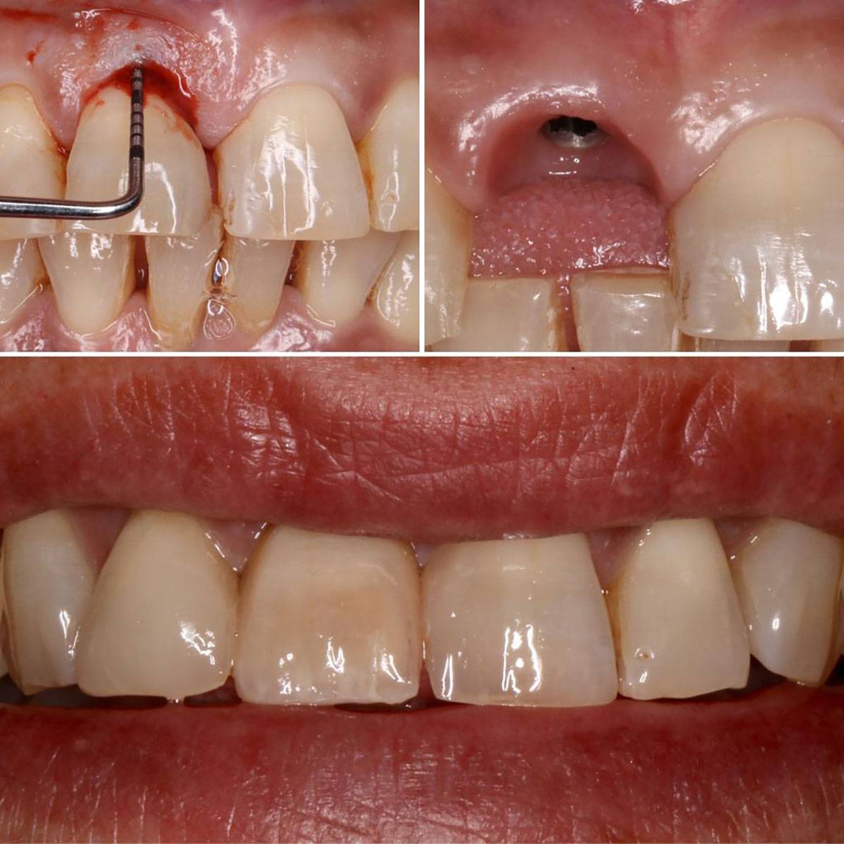 TRI Dental Implants: Webinars