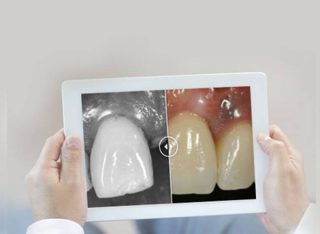 TRI Dental Implants: Start