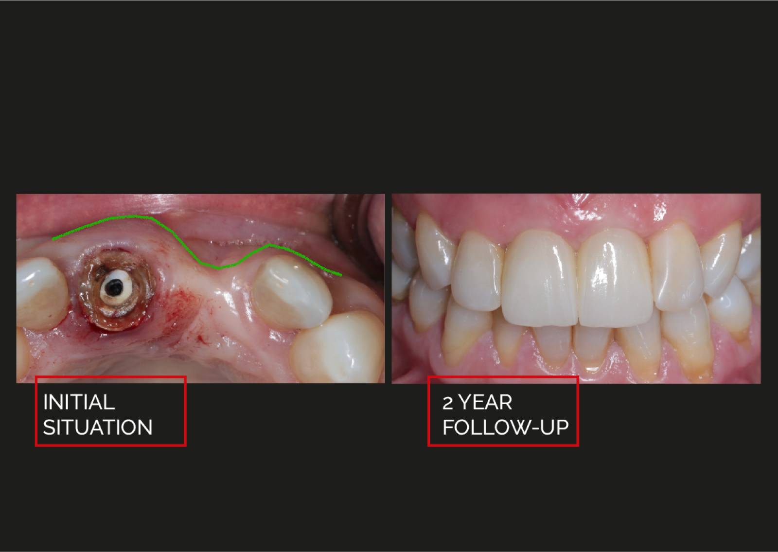 TRI Dental Implants: Cases
