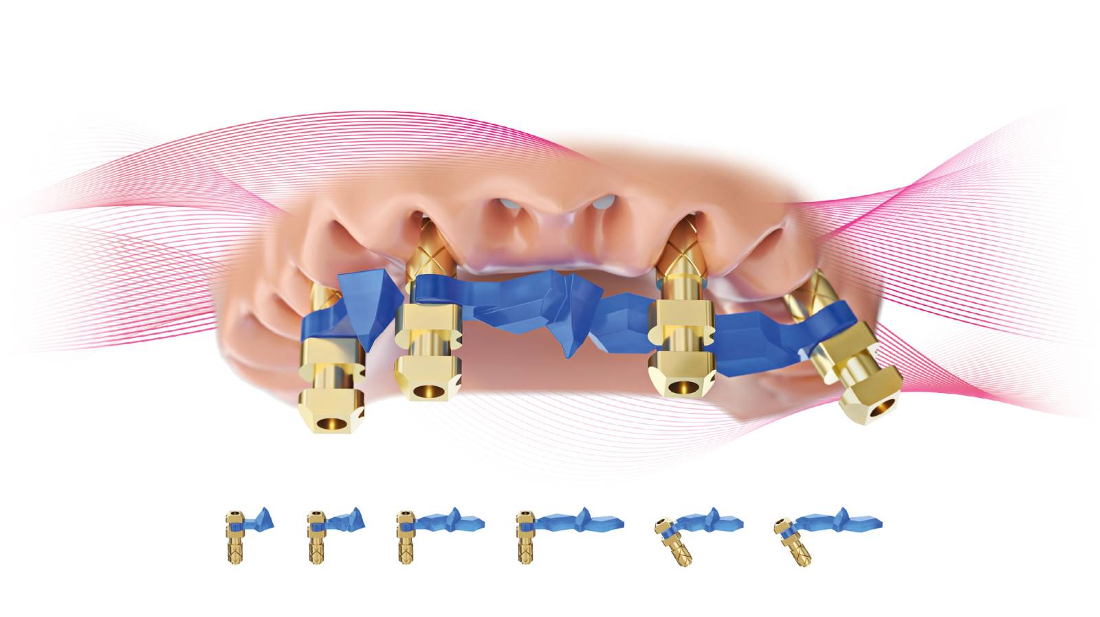 TRI Dental Implants: All-on-X